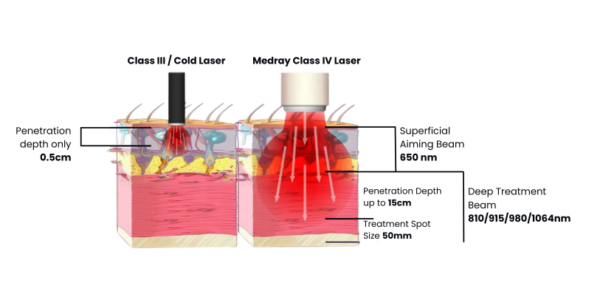 Top 4 Biological Effects of Class IV Laser Therapy