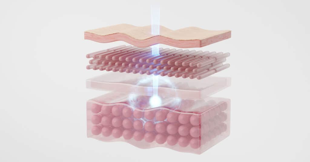 Today's Deep Tissue Laser Therapy Is All About Class IV Lasers - Medray ...
